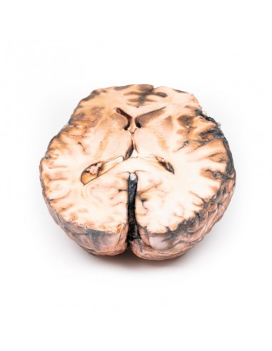 Aneurisma sacular - Erler Zimmer Série de anatomia 3D MP2013